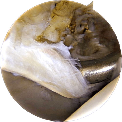 Artroscopia de cadera – ARTHROSPORT